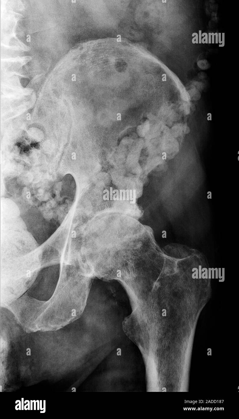 La scintigraphie osseuse du myélome, X-ray. Le myélome multiple est un ...