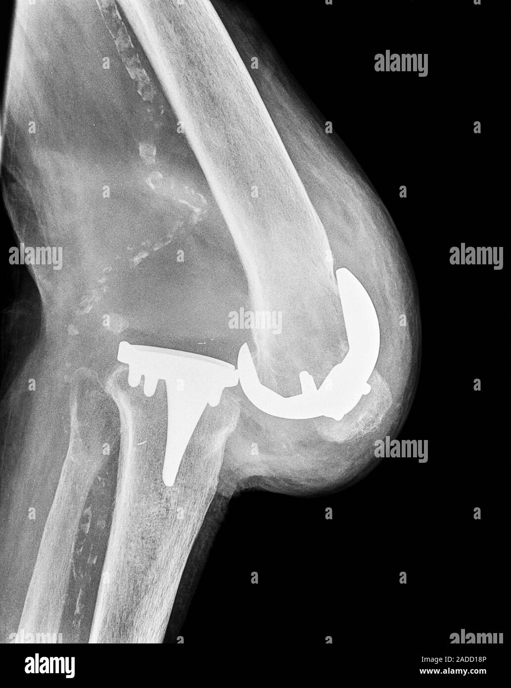 Luxation du genou. X-ray de la luxation de genou d'un 92-year-old woman ...