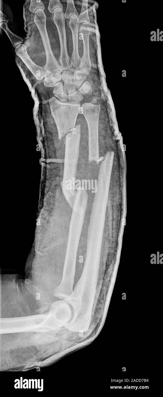 Bras inférieur fracturé les os, X-ray. Ces fractures du radius et ...