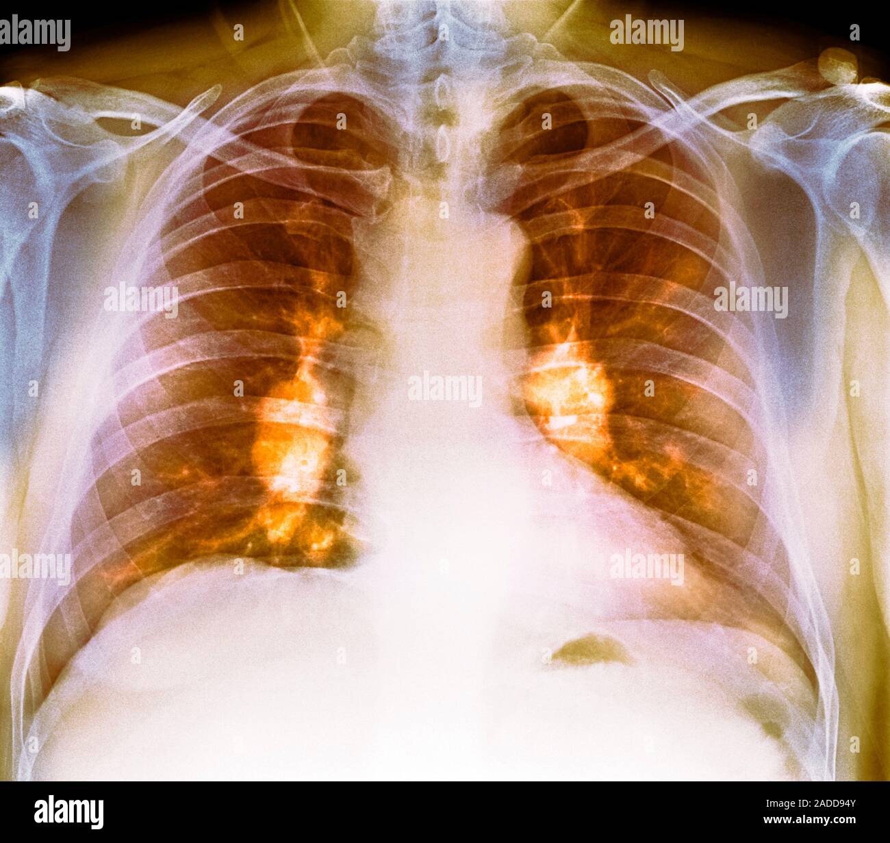La sarcoïdose. Frontal couleur radiographie des poumons d'un homme de ...