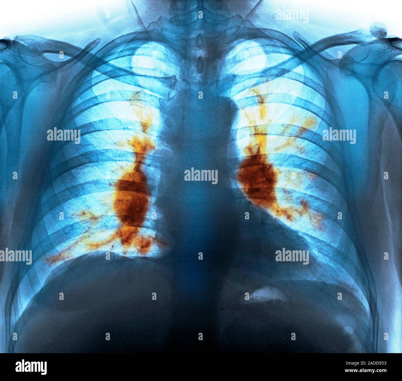 La sarcoïdose. Frontal couleur radiographie des poumons d'un homme de ...