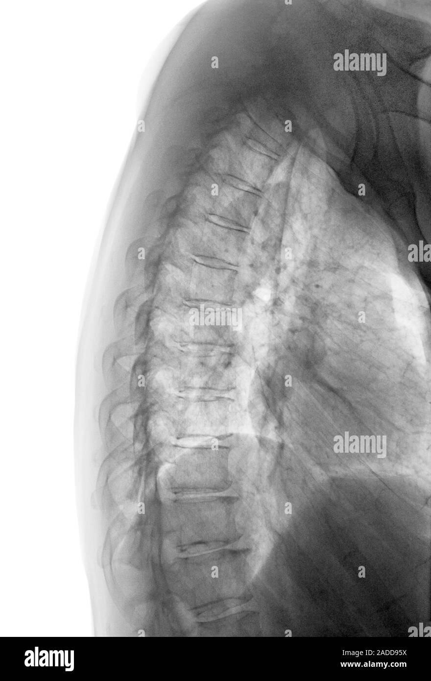 L'arthrose de la colonne vertébrale. Radiographie latérale de la ...