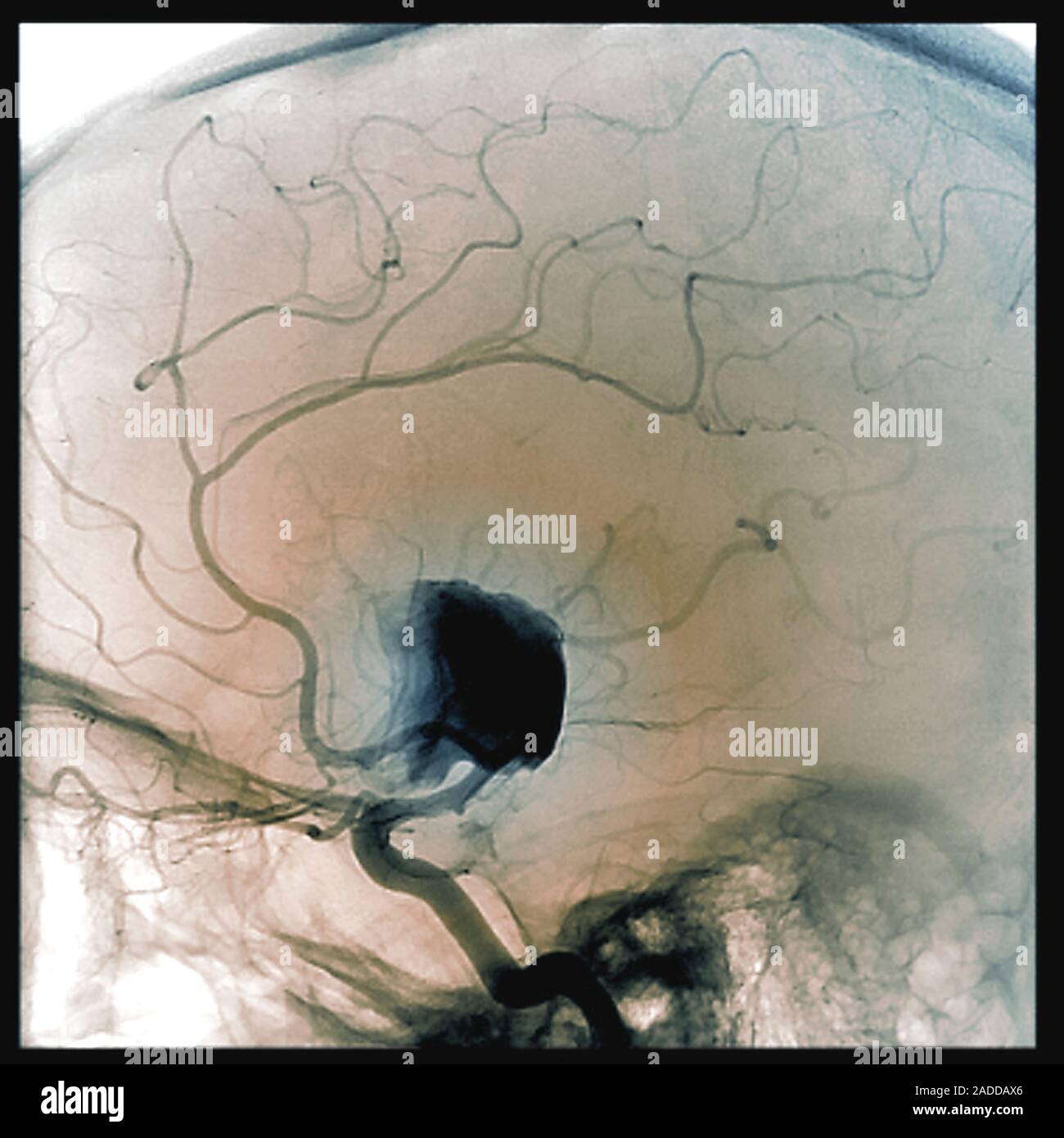 L'anévrisme cérébral. Angiogramme de couleur (vaisseau sanguin X-ray ...