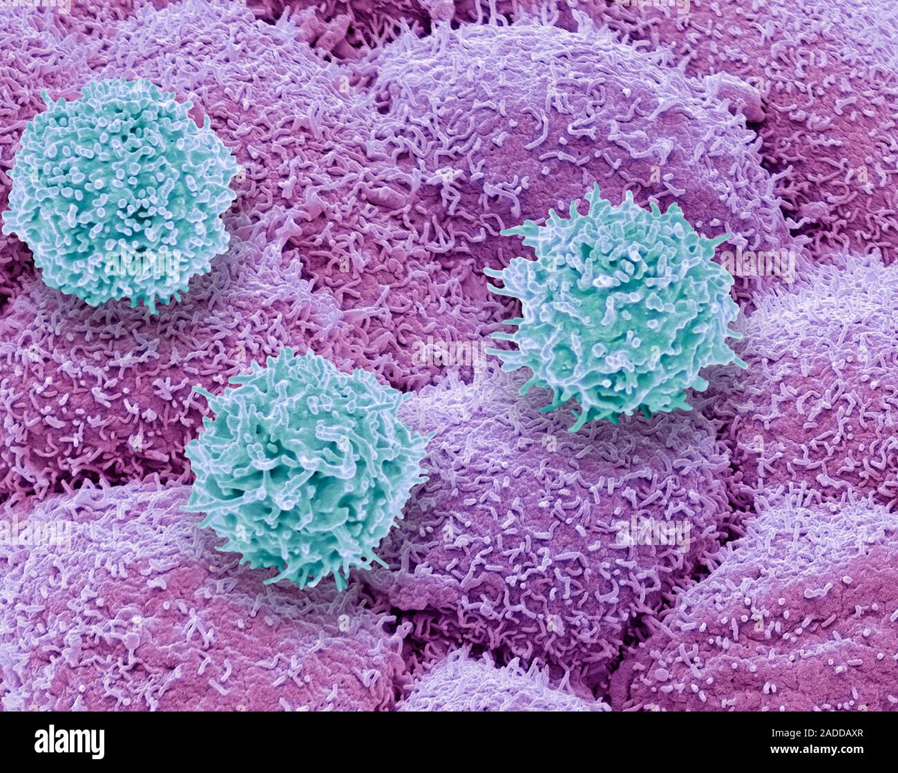 Les lymphocytes T et les cellules du cancer de la prostate. Couleur ...