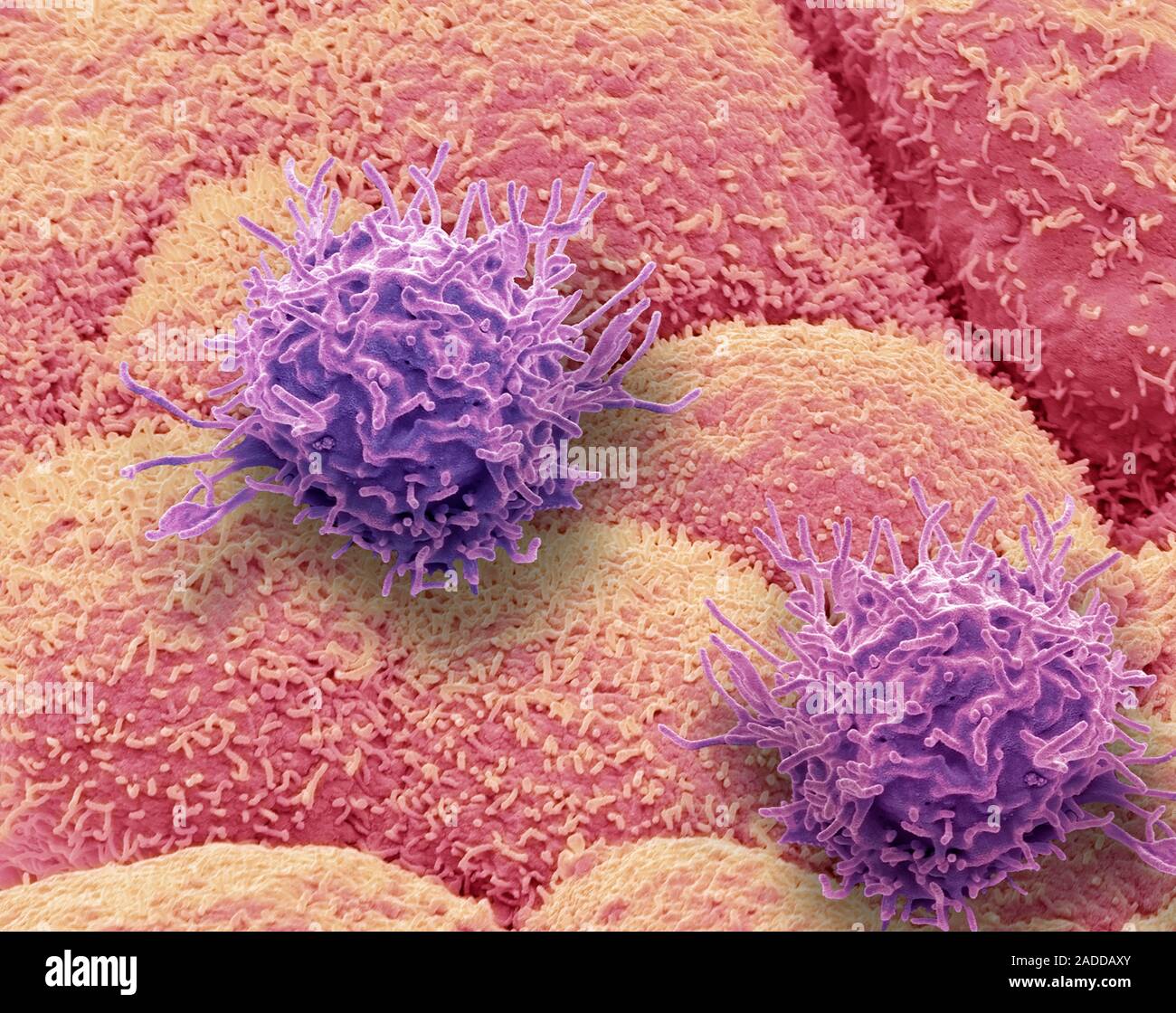 Les lymphocytes T et les cellules du cancer de la prostate. Couleur ...