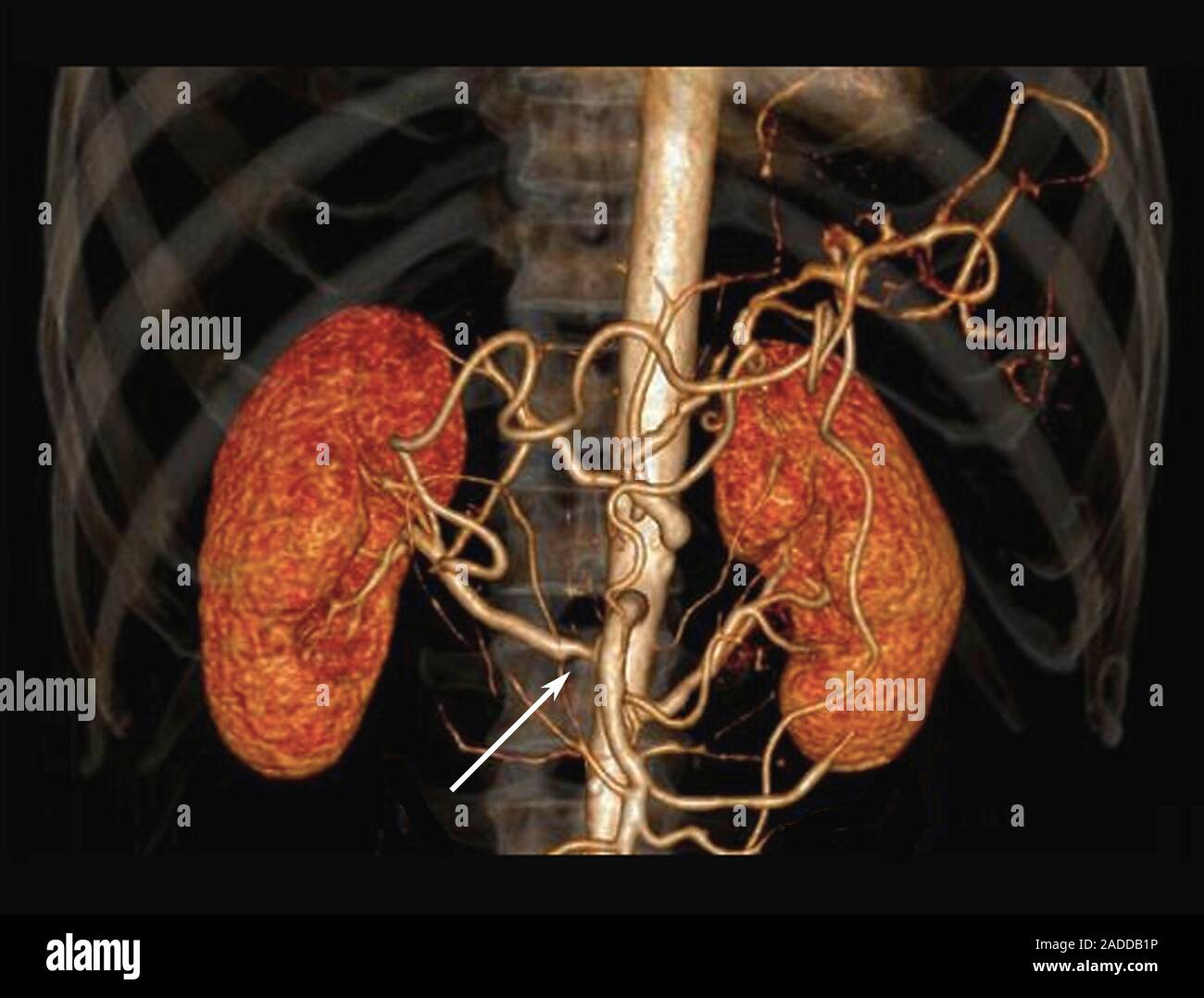 L'hypertension et de sténose de l'artère rénale. 3D couleur la ...