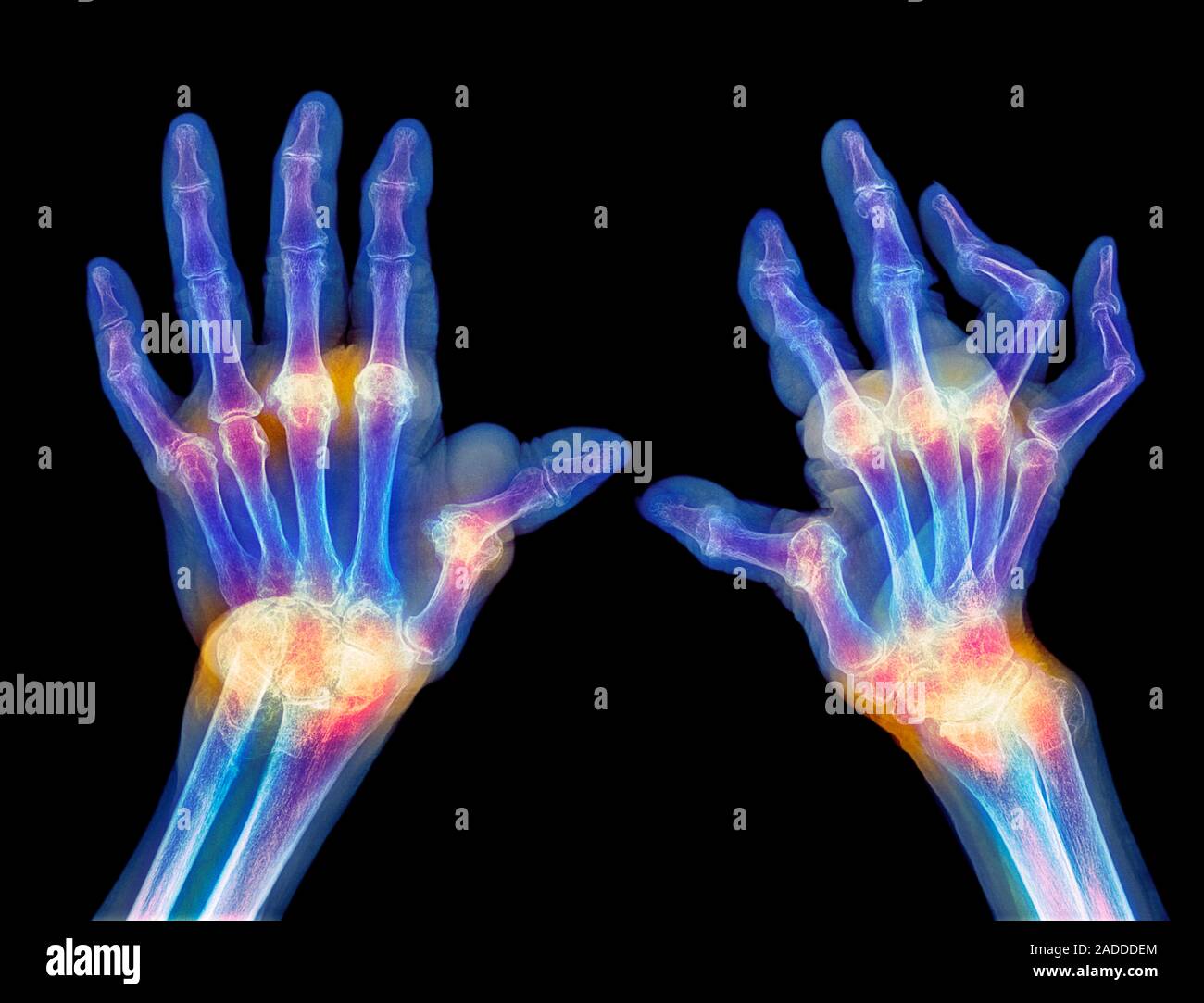 La polyarthrite rhumatoïde des mains. Bilatéraux couleur X-ray de la ...