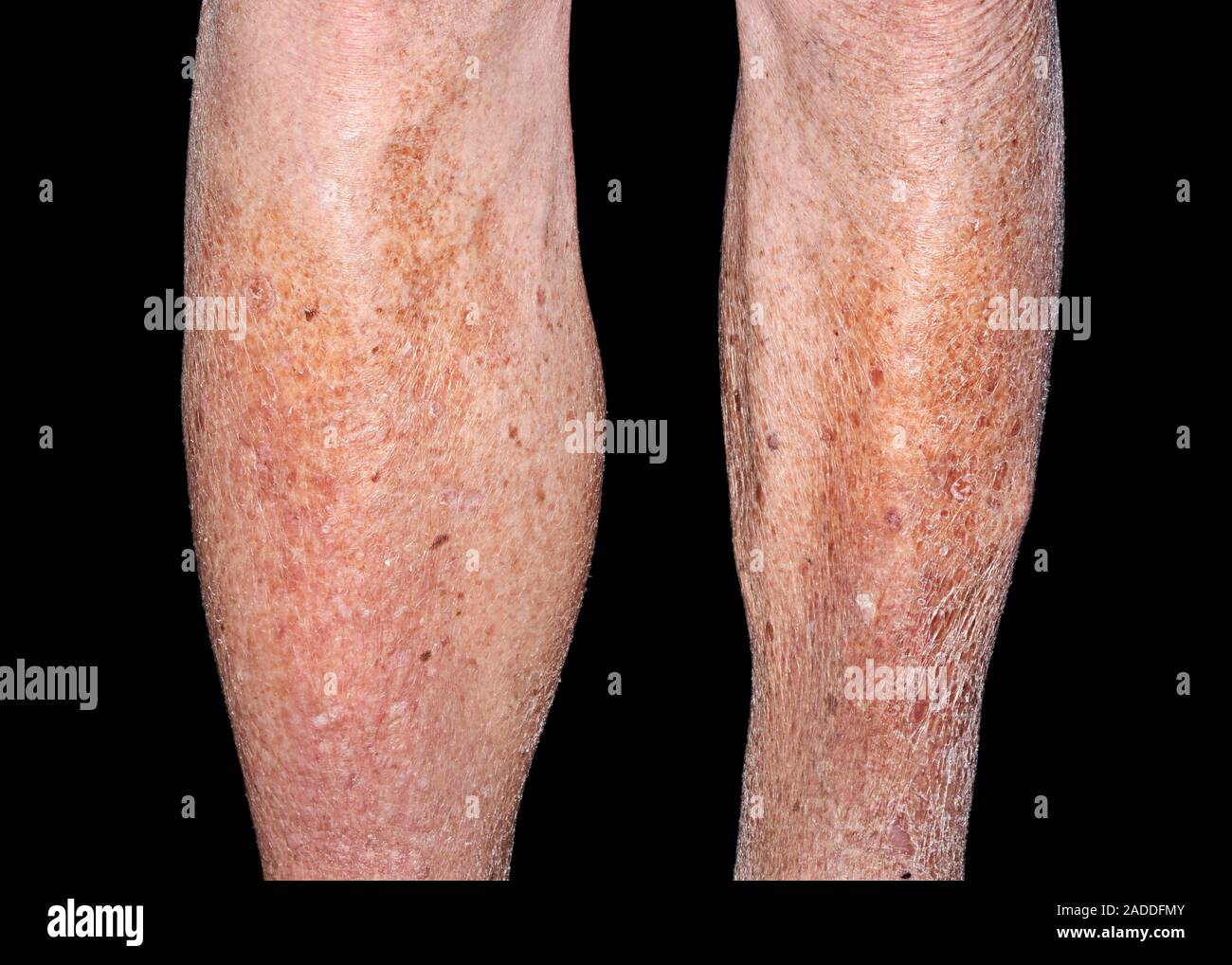 La cellulite sur le mollet droit gonflé (à gauche) d'un 91-year-old man ...