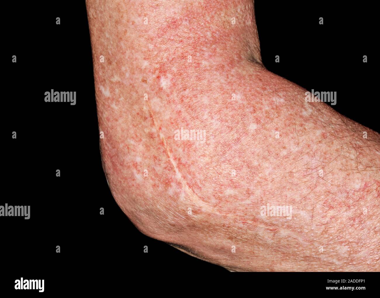 Coude de l'enflure post-opératoire (épanchement) dans un homme de 64 ...