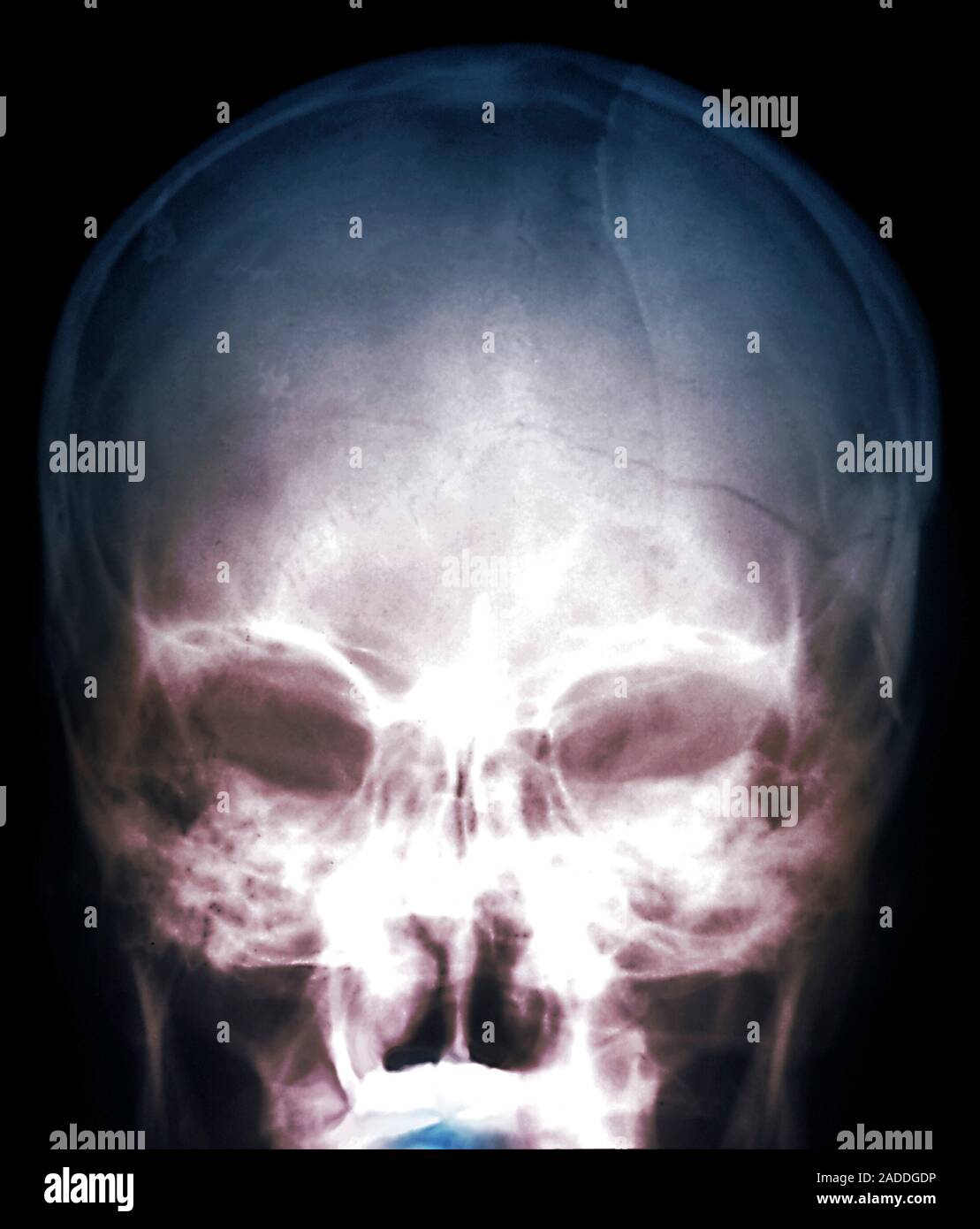 Fracture du crâne. X-ray frontal couleur du crâne d'un homme de 30 ans ...