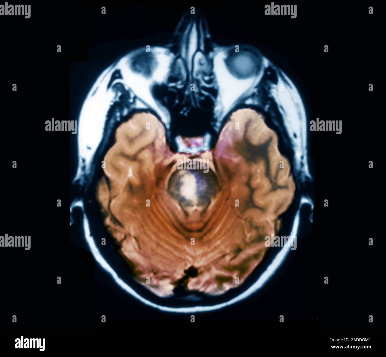 Avc du tronc cérébral. Axial de couleur l'imagerie par résonance ...