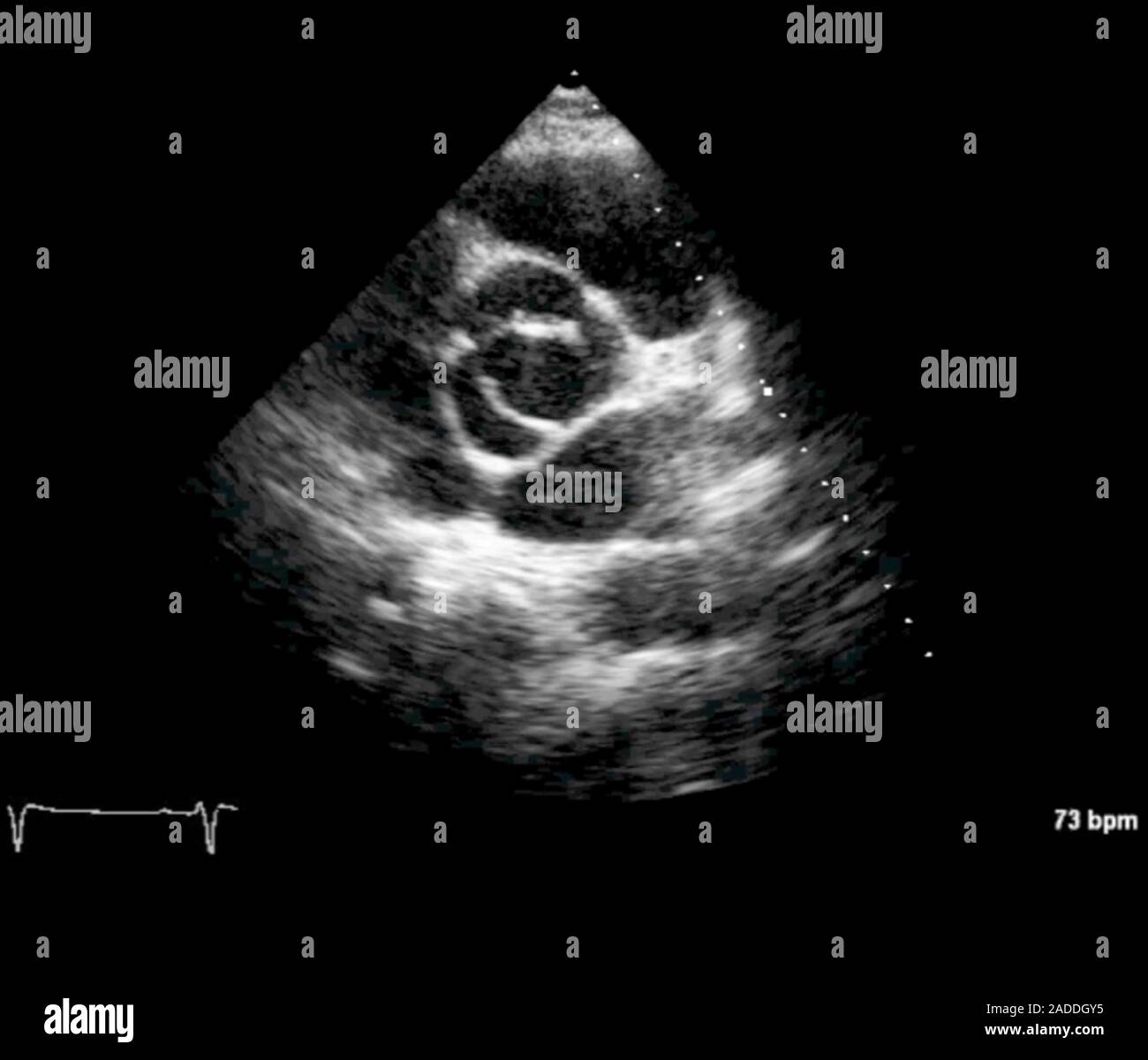 Malformation congénitale de la valve aortique. Échographie cardiaque du ...