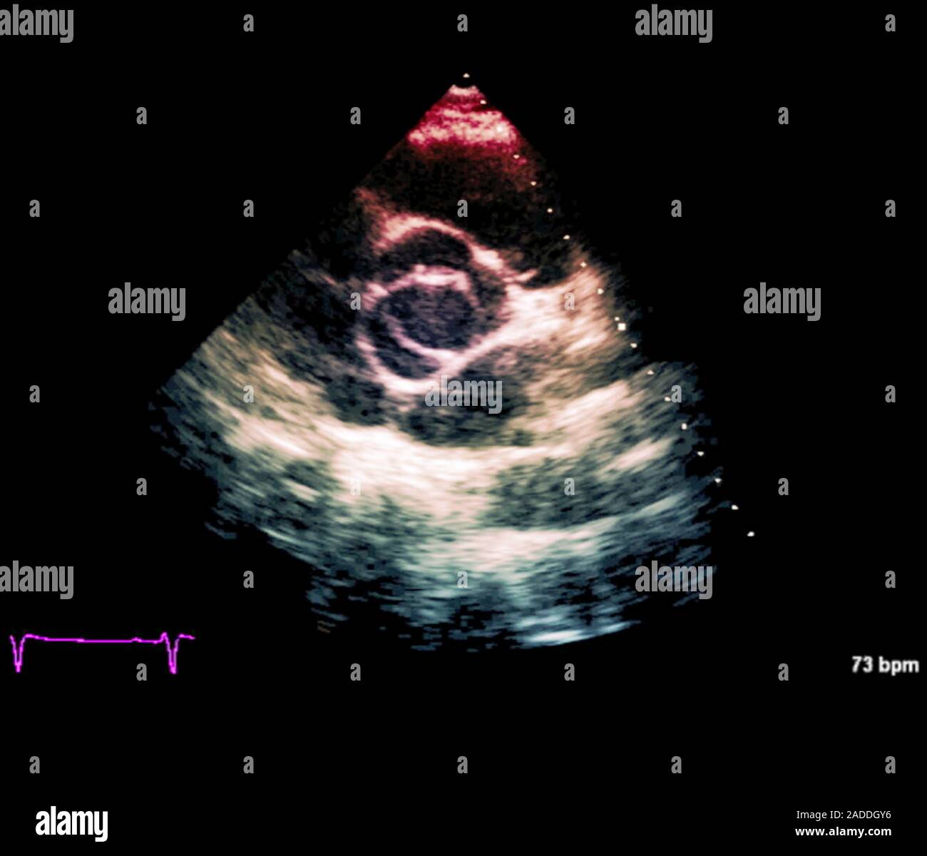Malformation congénitale de la valve aortique. Échographie cardiaque ...