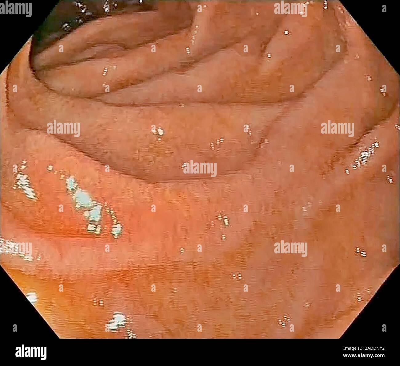 De l'antre gastrique. Compte tenu de l'endoscope (partie inférieure) de ...