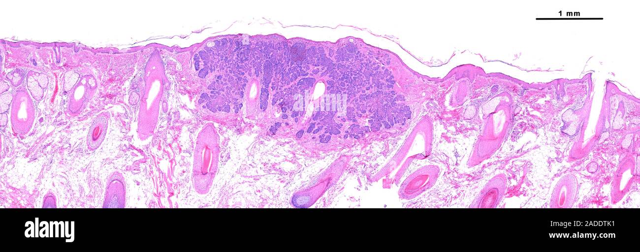 Le carcinome basocellulaire, lumière microphotographie. Les cellules basales (trichoblastic ...