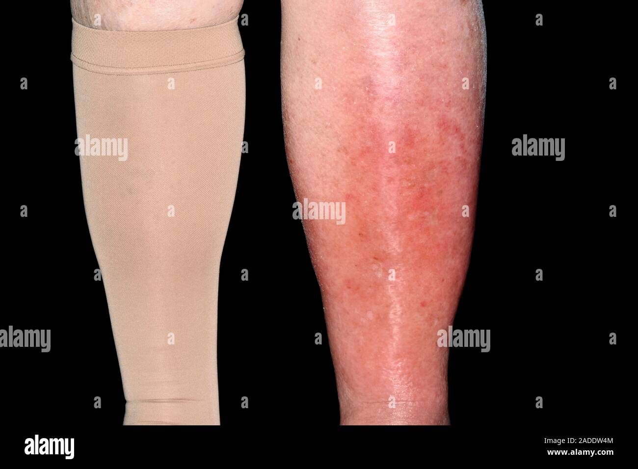 La cellulite de la jambe. Close-up des jambes de 88 ans, montrant l ...