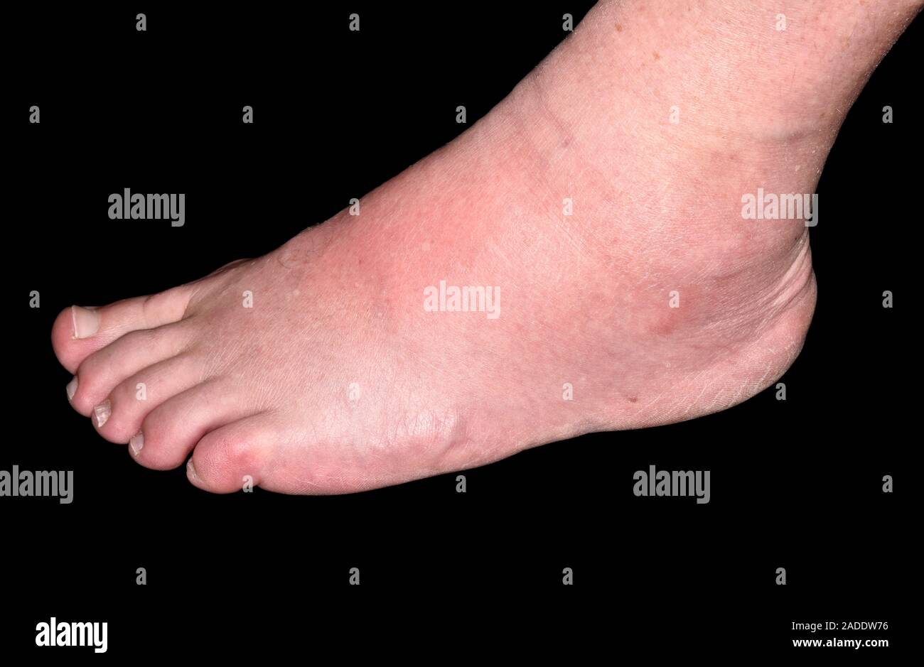 La goutte du pied. Close-up du pied enflé d'un 50-year-old male patient ...