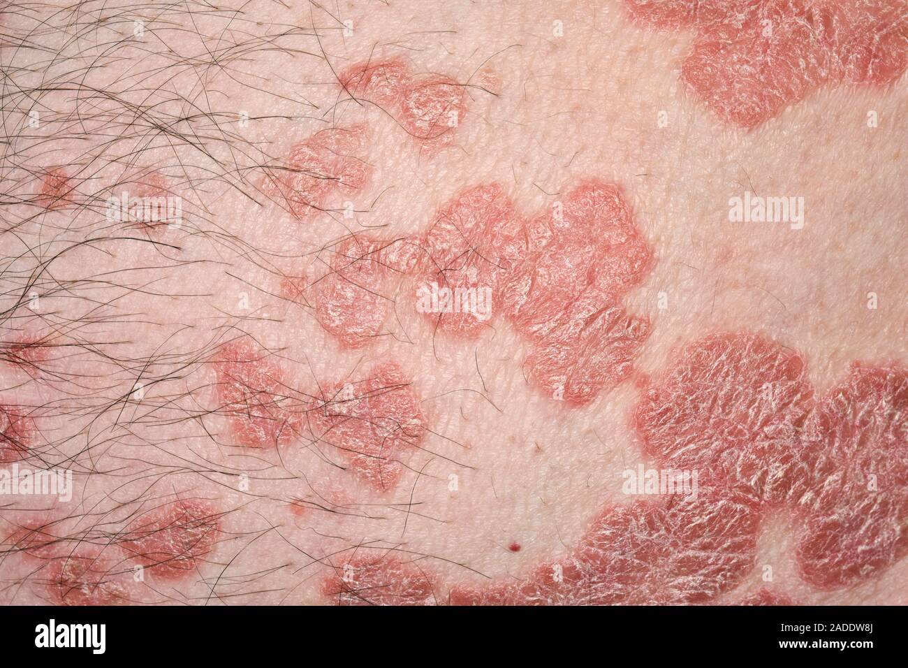 Le psoriasis en plaques. Close-up de lésions squameuses sèches sur la ...