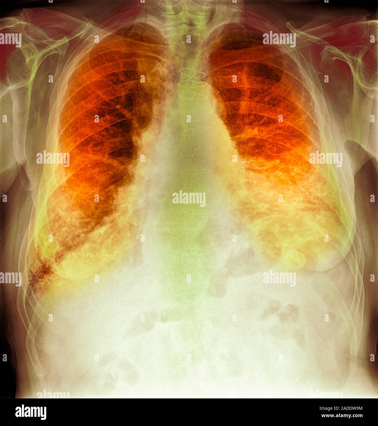La fibrose pulmonaire. Radiographie de la couleur d'un d'un 91-year-old ...