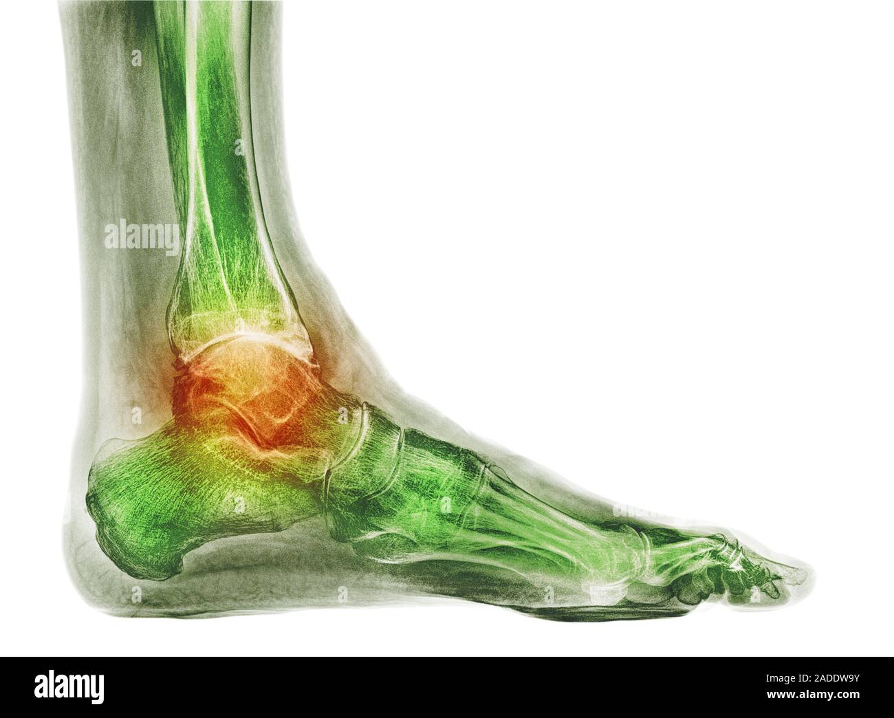 L'arthrose de la cheville. X-ray de couleur de la cheville d'un 73-year ...