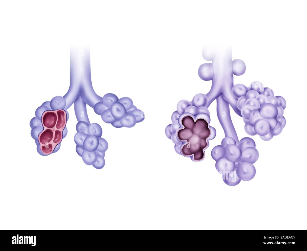 Les maladies pulmonaires et les alvéoles, de l'illustration. Alvéoles ...