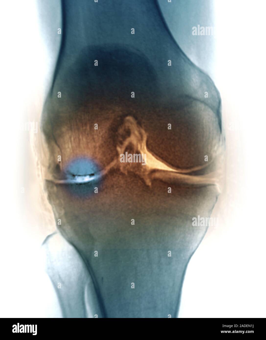L'arthrose de l'articulation du genou. Image composite de la couleur de ...