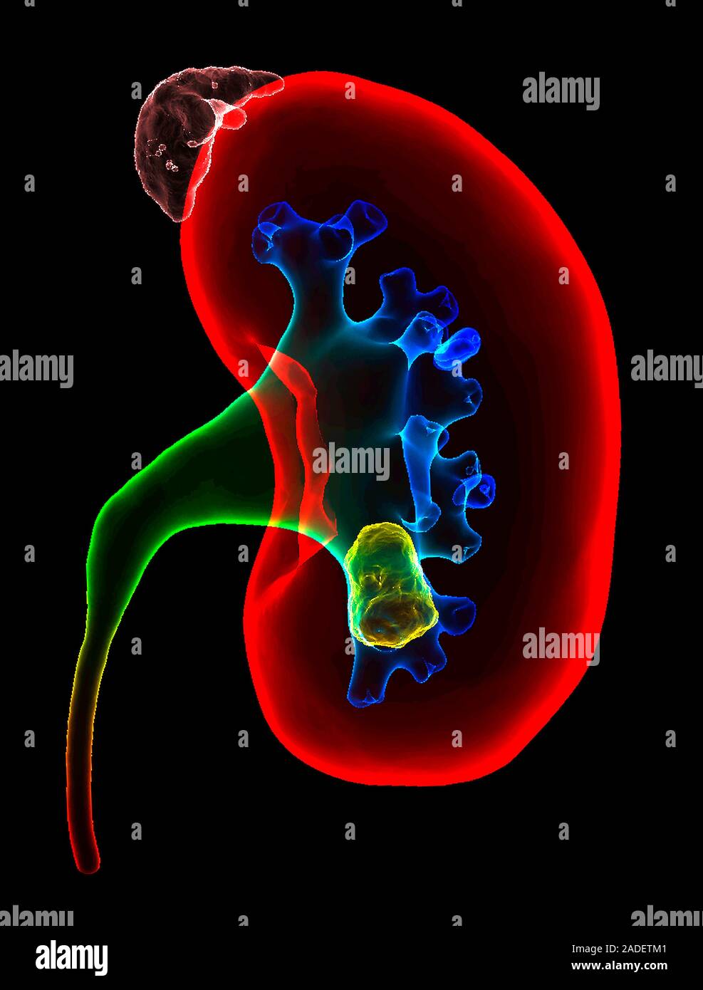 La pierre de rein. Illustration d'un rein (semi-transparente) avec une ...