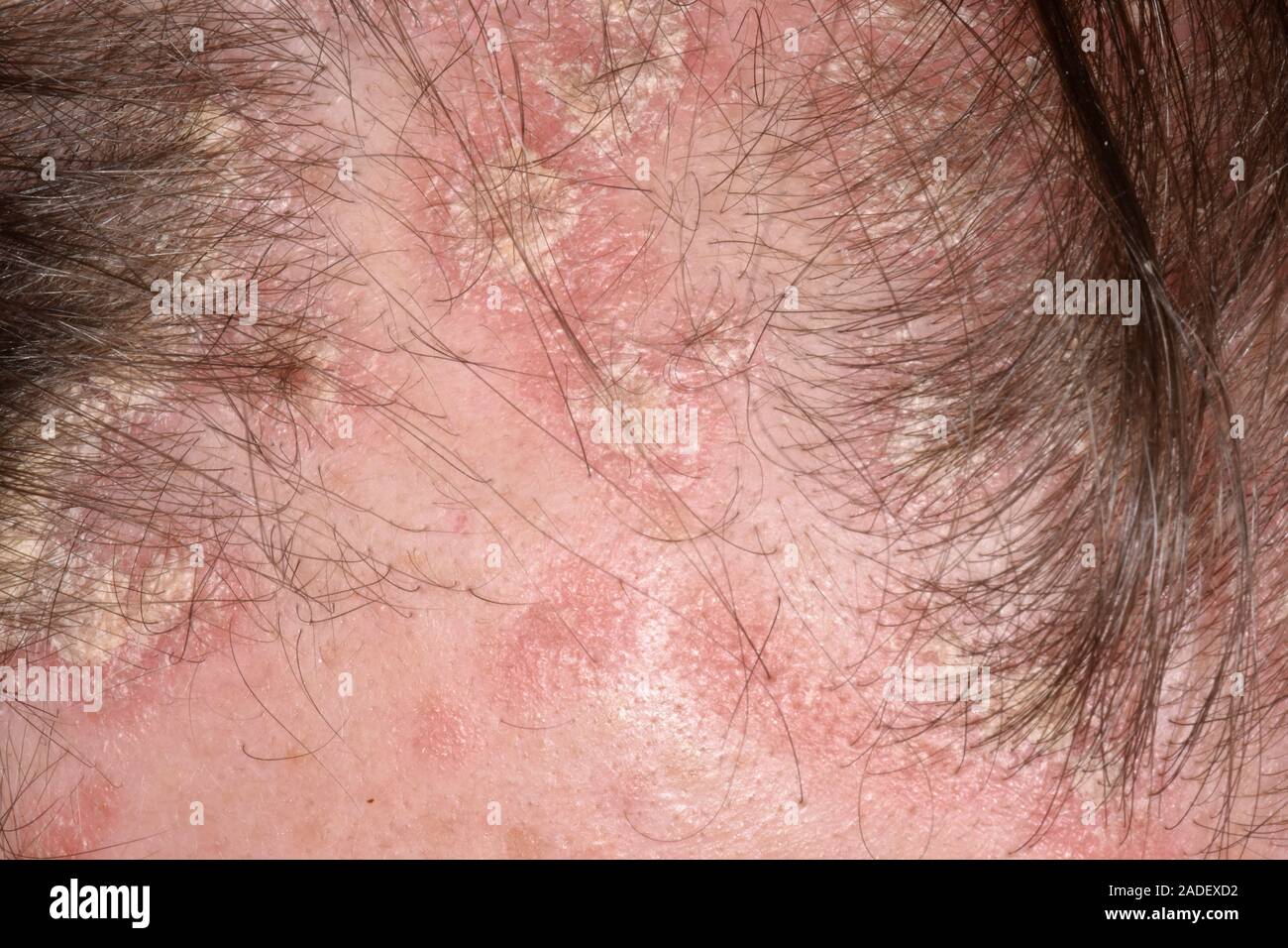 Parution du modèle. Le psoriasis du cuir chevelu touchant un 44-year ...