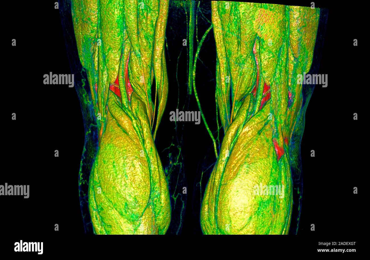 Les muscles et les articulations du genou. 3D computed tomography (CT ...