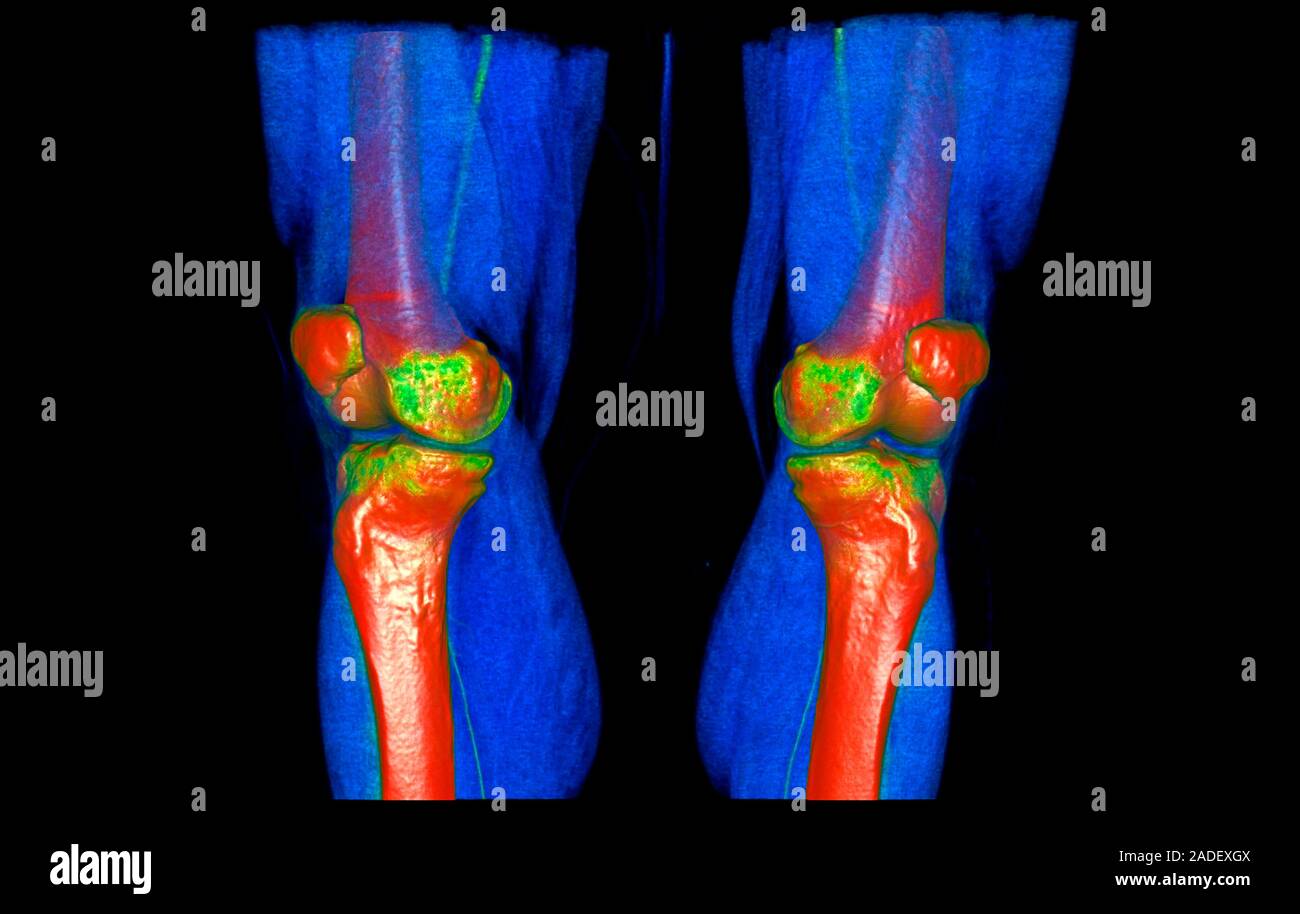 Les muscles et les articulations du genou. 3D computed tomography (CT ...