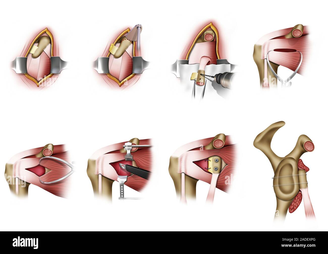 Prévention de la luxation de l'épaule chirurgie, illustration. Cette ...