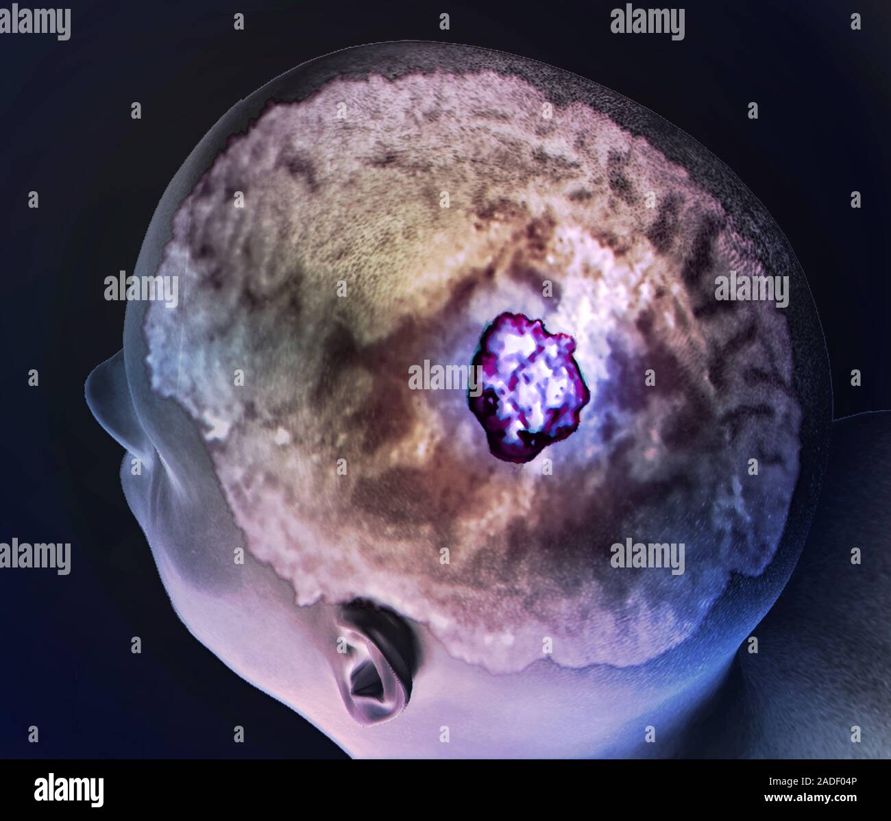 Tumeur au cerveau. 3 dimensions couleur l'imagerie par résonance magnétique (IRM) du cerveau d ...