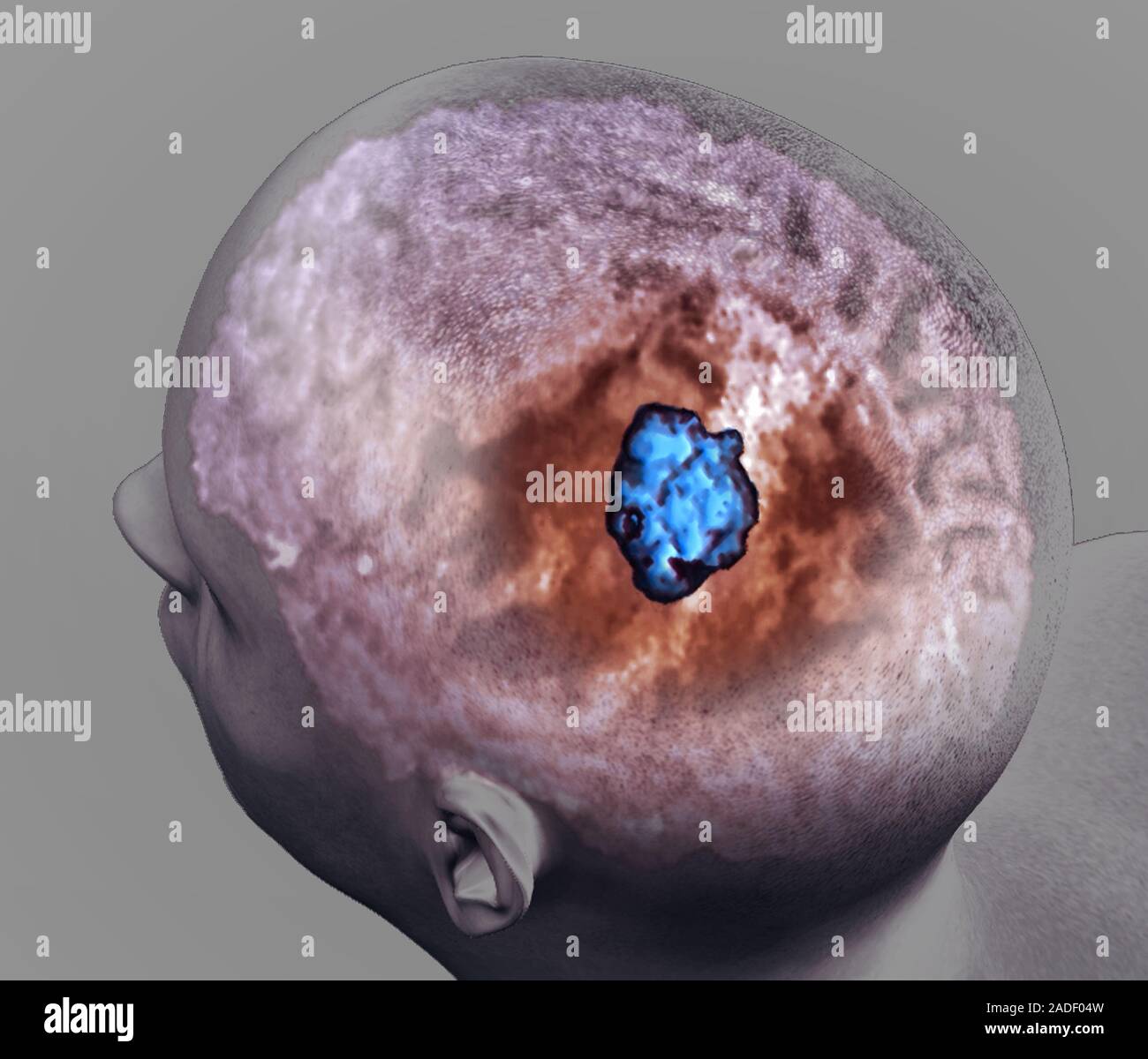 Tumeur au cerveau. 3 dimensions couleur l'imagerie par résonance magnétique (IRM) du cerveau d ...