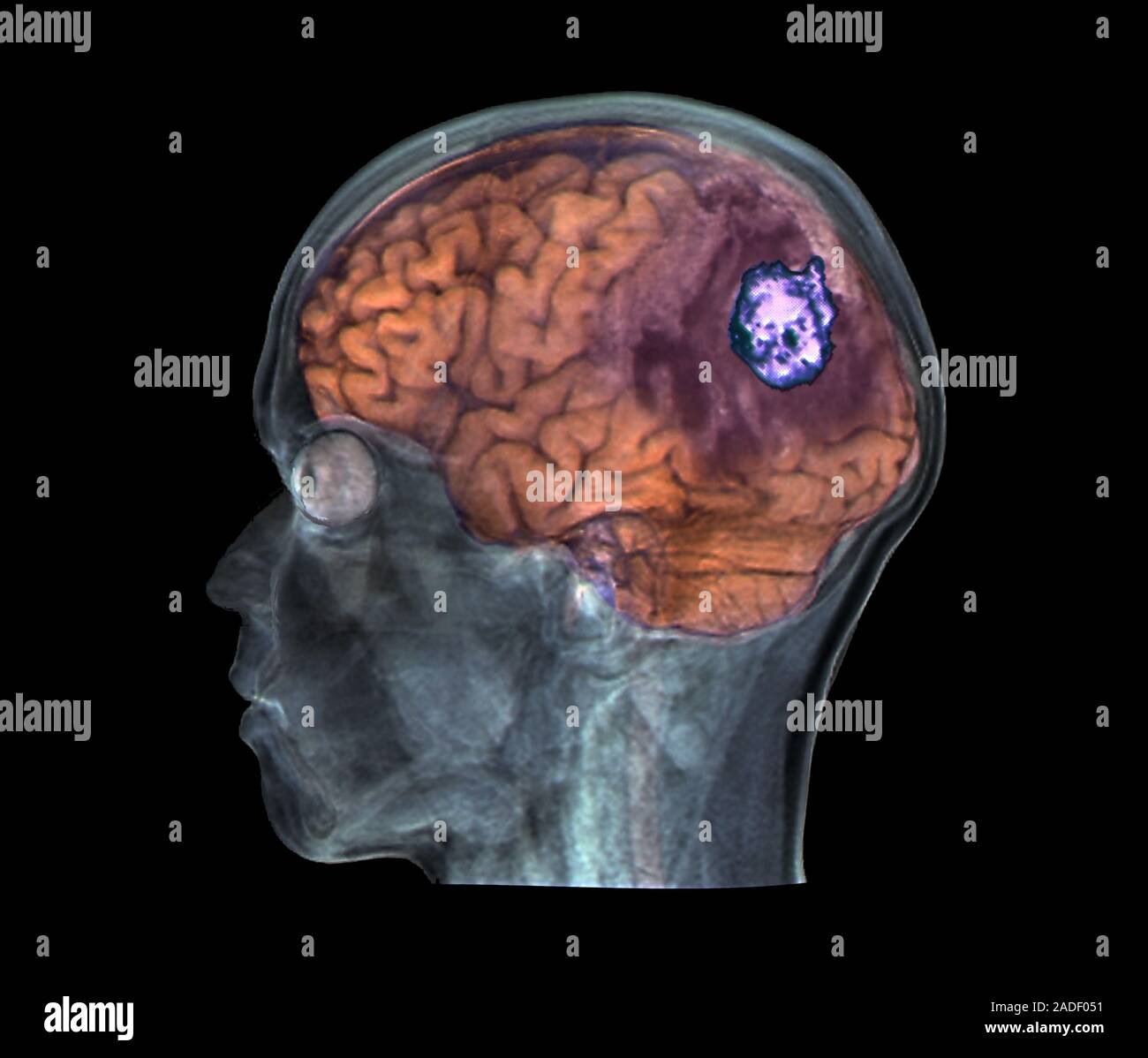Tumeur au cerveau. 3 dimensions couleur l'imagerie par résonance magnétique (IRM) du cerveau d ...