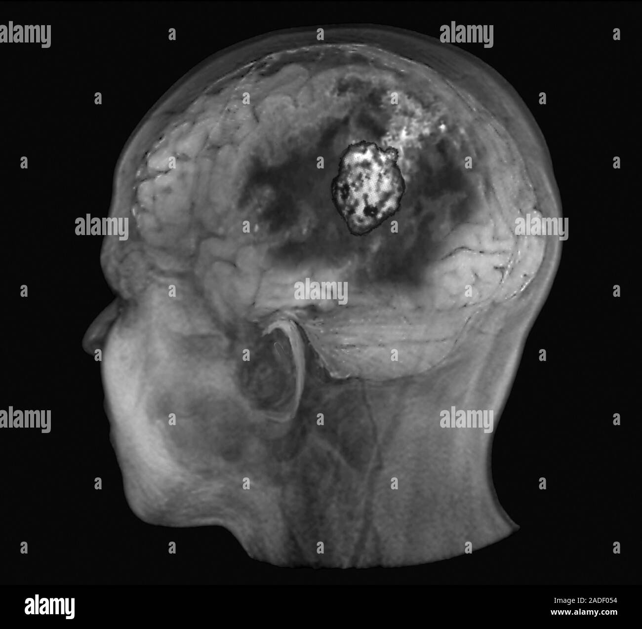 Tumeur au cerveau. 3 dimensions de l'imagerie par résonance magnétique (IRM) du cerveau d'un 60 ...