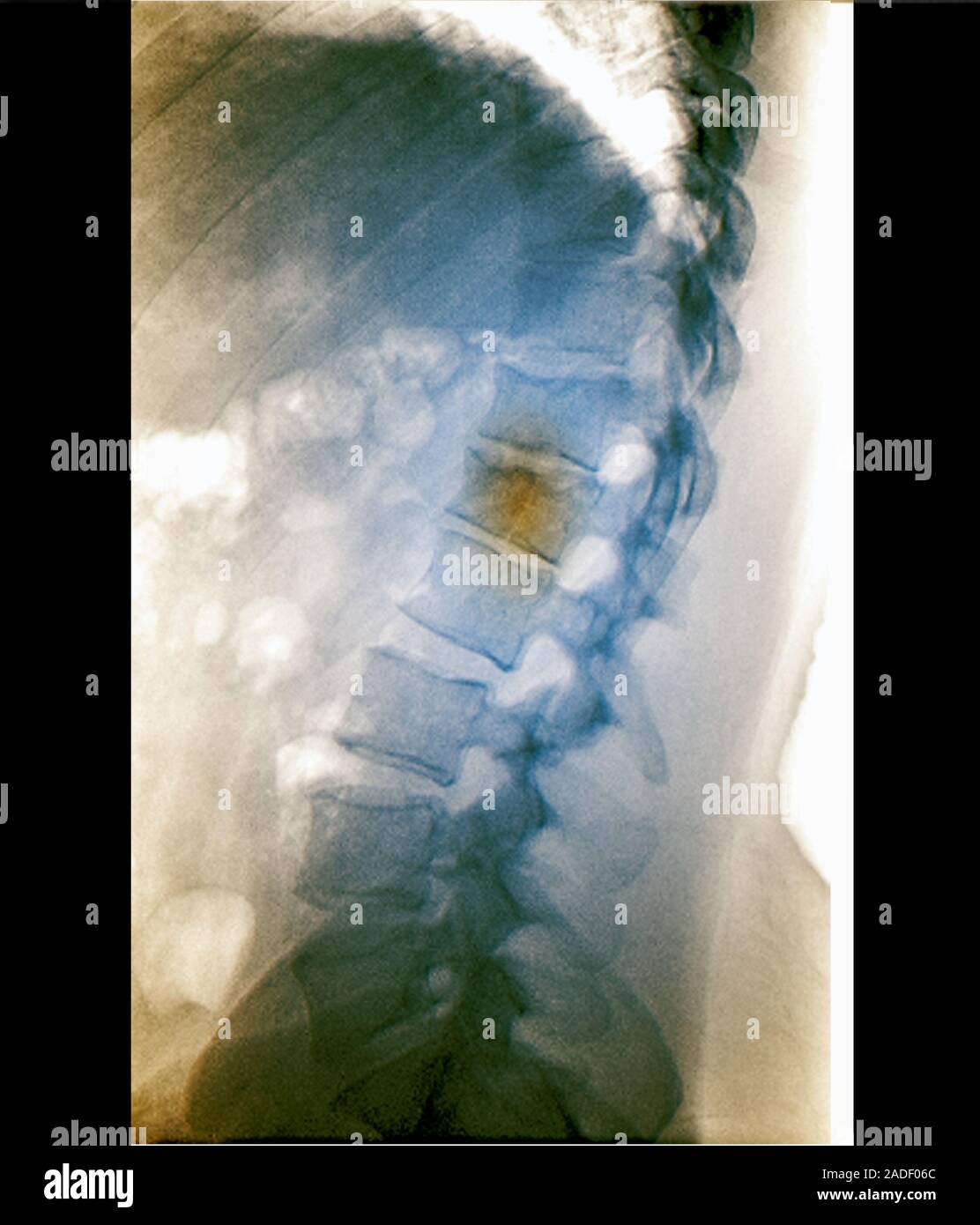 La fracture vertébrale. X-ray de couleur d'une section à travers la ...