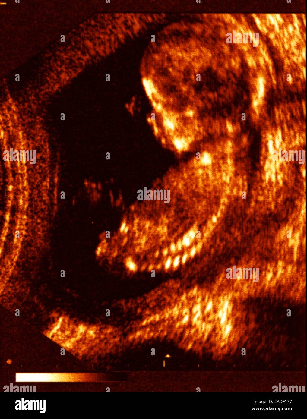 Échographie d'un fœtus à 14 semaines. Le fœtus se développe à partir de ...