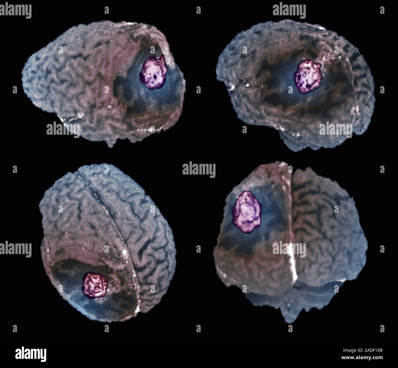 Un gliome en récidive tumeur au cerveau. 3D couleur de l'imagerie par résonance magnétique (IRM ...