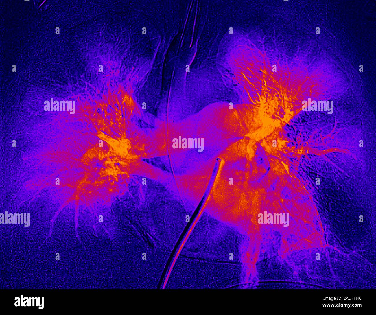 L'embolie pulmonaire, l'angiogramme de couleur (vaisseau sanguin X-ray ...