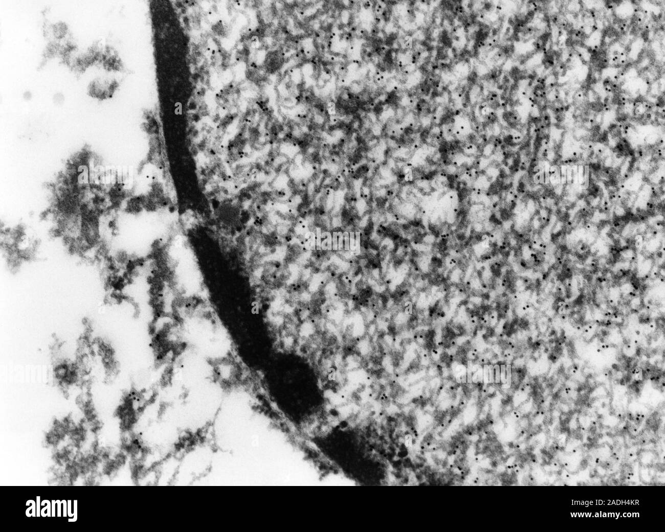 Encéphalite de rougeole. Micro-électronique à transmission- graphique d ...