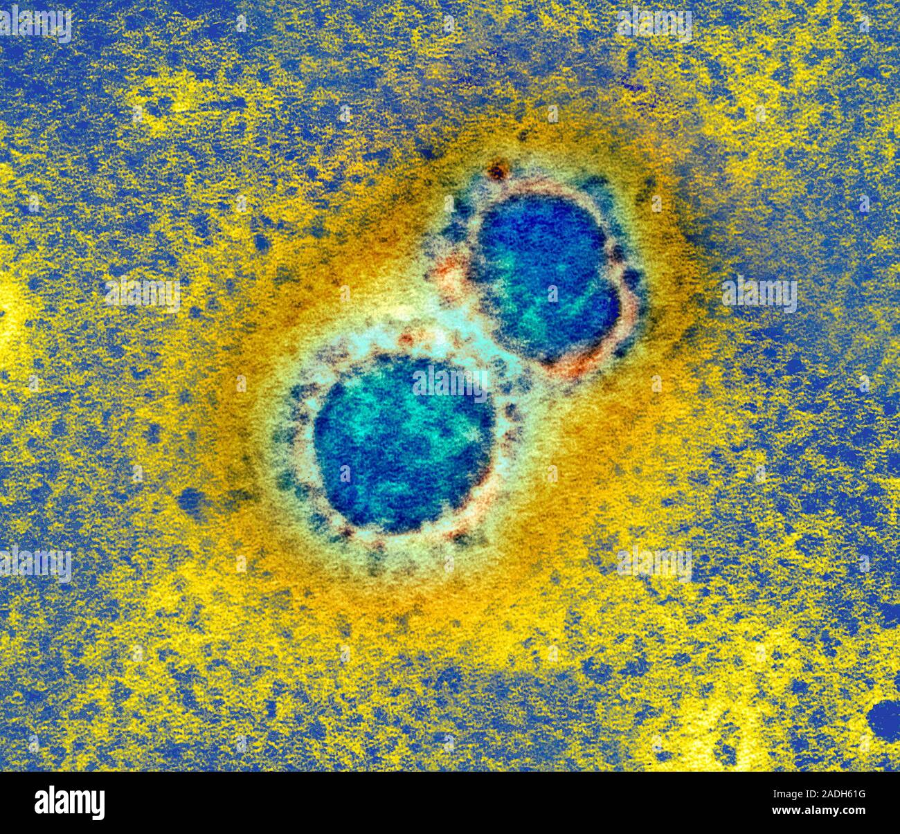 Les particules de virus du SRAS. Micrographe de couleur (MET) de deux ...