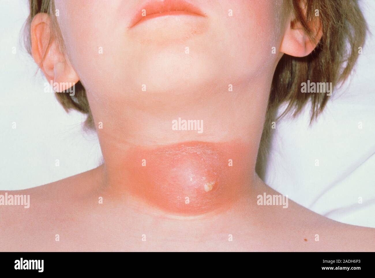 Abcès sur le cou d'un jeune enfant. Un abcès est une collection de pus ...