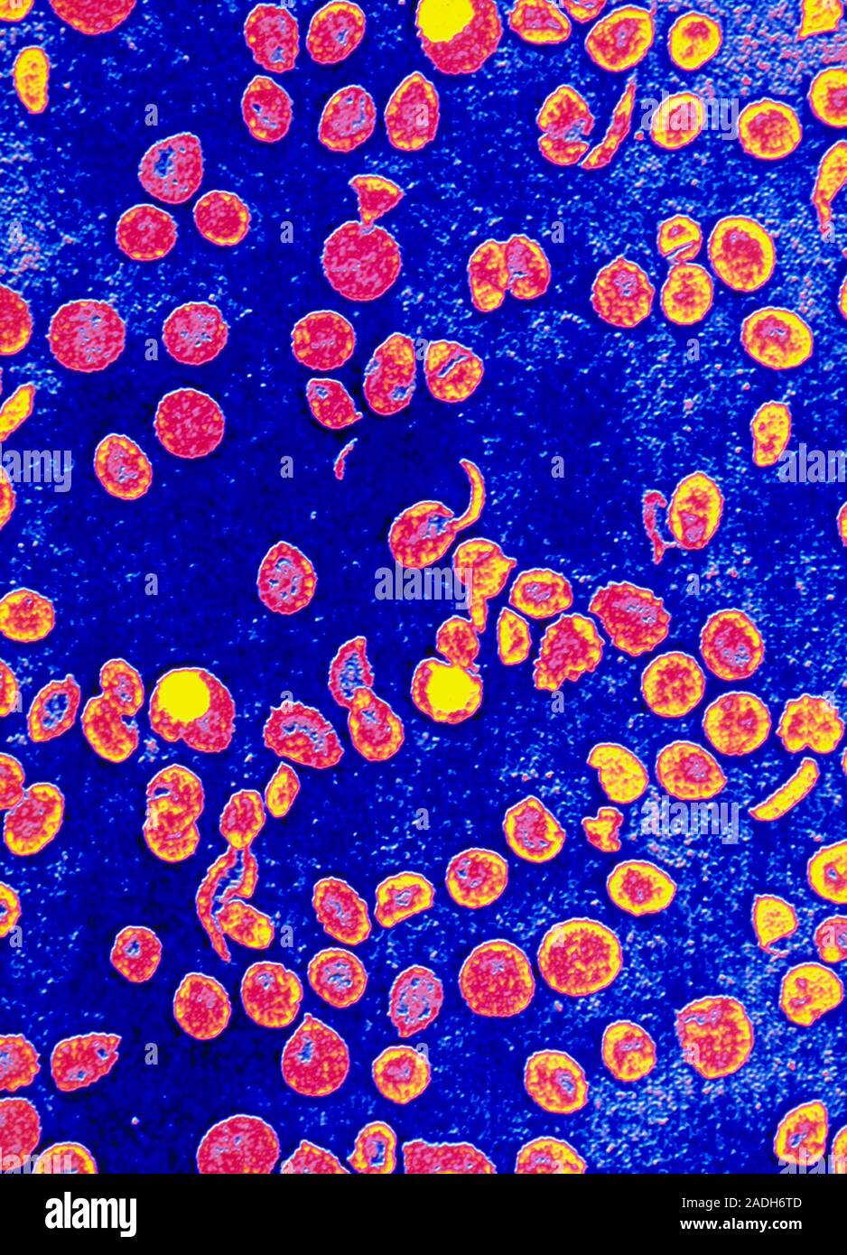 La drépanocytose. Microphotographie lumière colorée d'un frottis ...