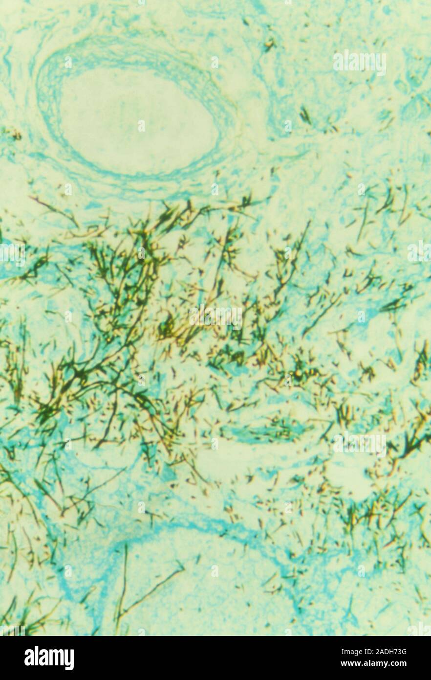 L'aspergillose. Microphotographie lumière d'une section d'un poumon ...