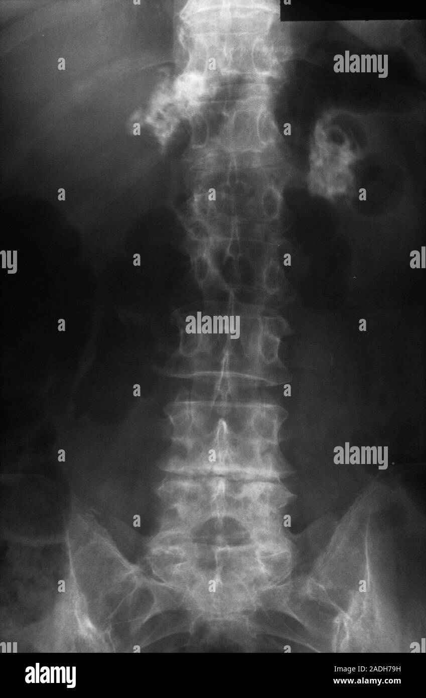 La maladie d'Addison. Radiographie de l'abdomen d'un patient ayant la ...