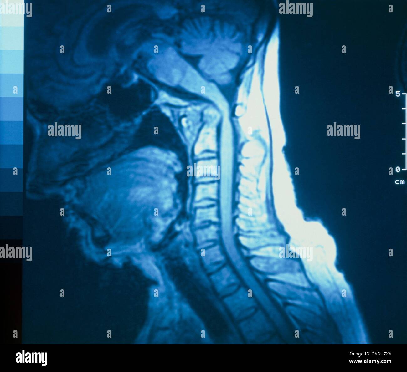 L'arthrite rhumatoïde. L'image par résonance magnétique (IRM) du cou d ...