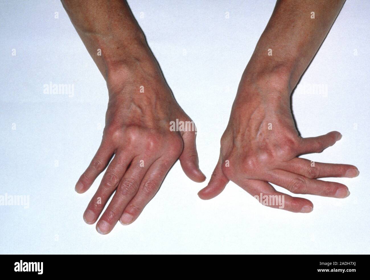 Les joints de déformation dans les mains d'un patient souffrant d ...