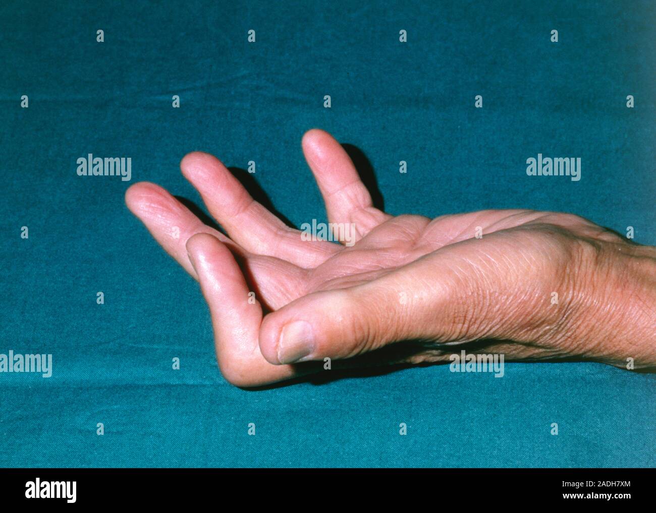 Les contractures de la flexion de la main d'un patient atteint de ...