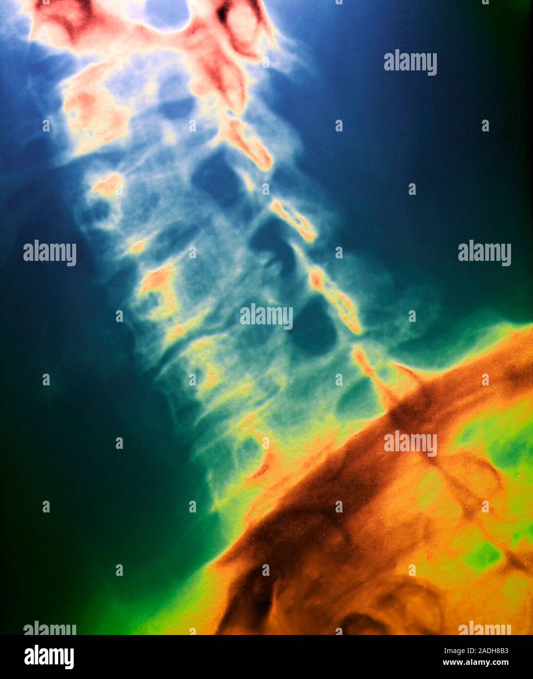 L'arthrose. X-ray de couleur d'une vue de côté du cou d'un patient avec ...