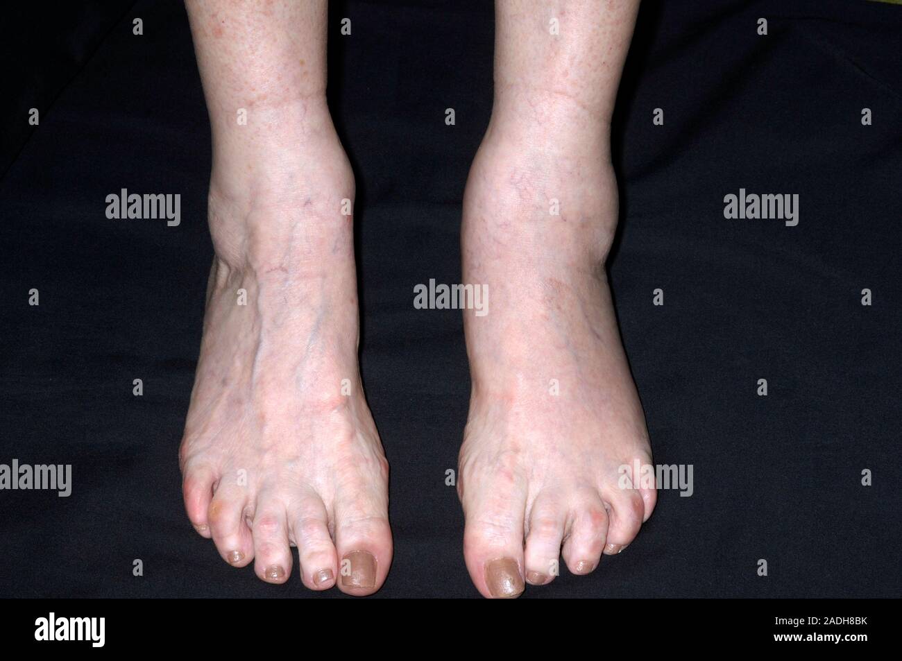 La cheville enflée. 74 ans, femme, et avec une cheville gonflée (à ...